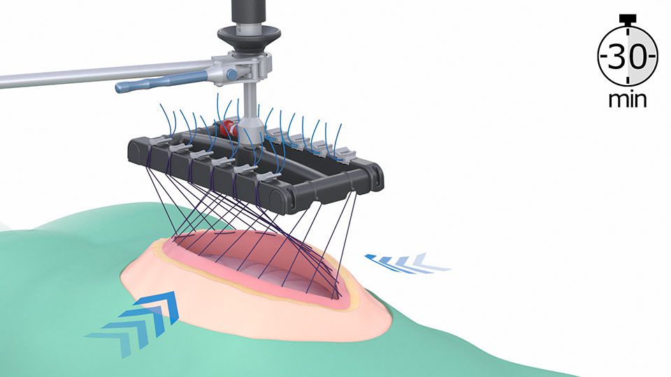 Fasciotens Abdominal Wall Solutions | PCU-BV
